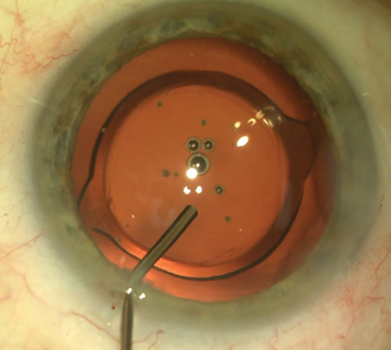 5 Things to Know About Intracameral Antibiotics - Outpatient Surgery M ...