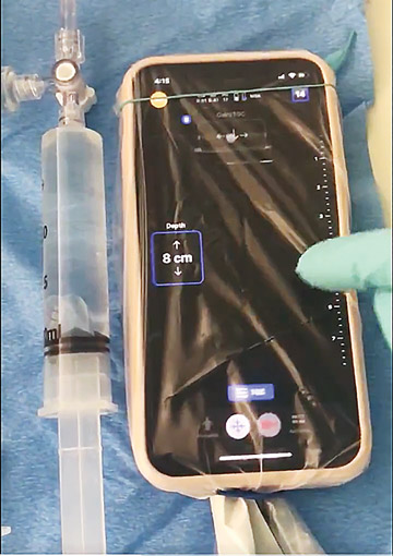 Ideas That Work: Block Placement - Outpatient Surgery Magazine - Novem ...